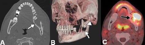 Median Mandibular Cyst