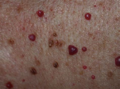 Little Red Spots On Skin