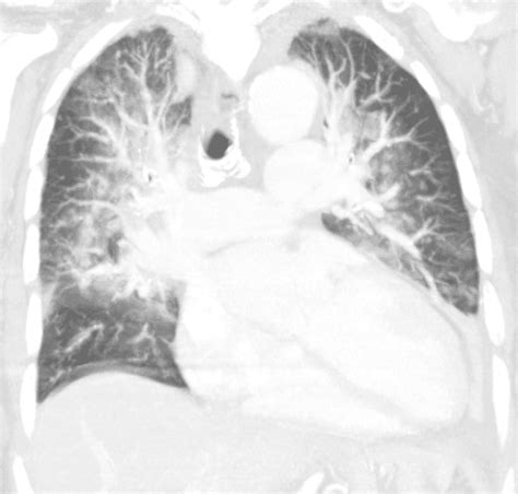Kombinasi Diuretik Thiazide Dengan Loop Diuretic Pada Terapi Gagal