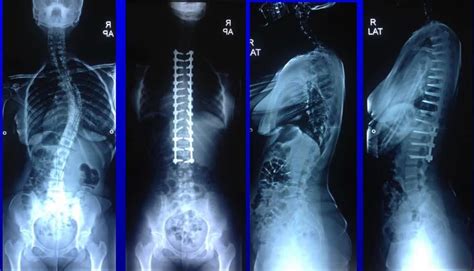 Advanced Spine Surgery Center Нуруу Нугасны Төв Public Group Facebook