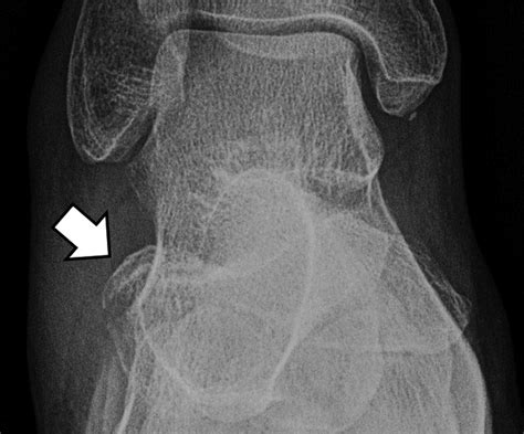 Anterior Calcaneus Fracture