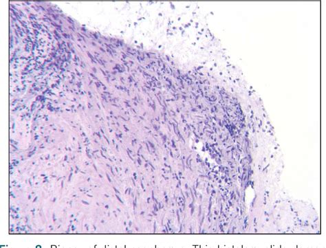Figure 2 From An Unusual Case Of Black Esophagus Semantic Scholar