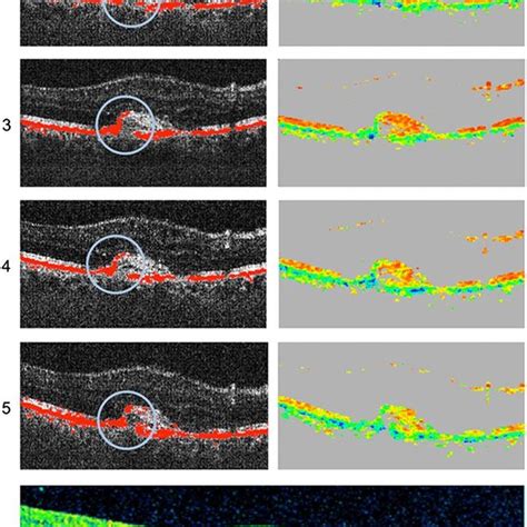 Comparison Of Rpe Atrophy Detection By Ps Oct And Intensity Based Download Scientific Diagram