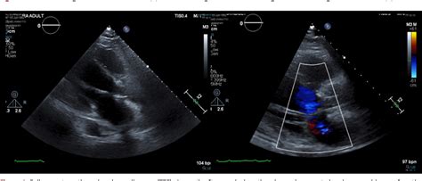 Figure 2 From Aerococcus Urinae Aortic Valve Endocarditis With Kissing Aortic Wall Ulcer A Case