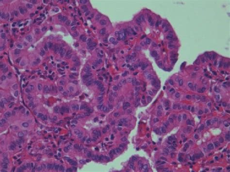 Ematossilina Eosina Sezione Istologica Di Cancro Papillare Download