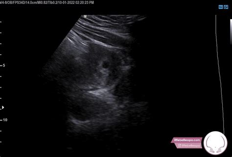 Leep Vs Repeat Colposcopy For Cin 2 Robgyn Leep Vs Repeat Colposcopy For Cin 2 Robgyn