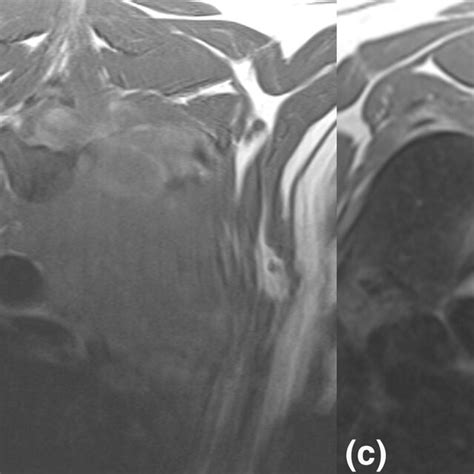Transverse T2‐weighted Pre‐ A And T1‐weighted Pre‐contrast B
