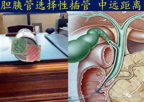 Ercp图解 千图网