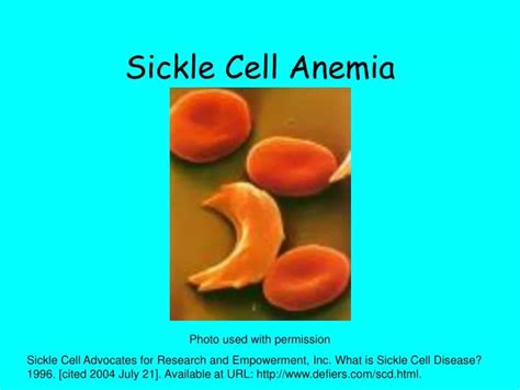Ppt Sickle Cell Anemia Powerpoint Presentation Free Download Id702101