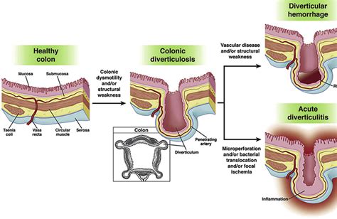Colonic Diverticula Form When Mucosa And Submucosa Herniate Through The