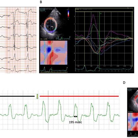 Waveform Recording Of The Intra‐left Ventricular Pressure And The Pcwp Download Scientific Waveform Recording Of The Intra‐left Ventricular Pressure And The Pcwp Download Scientific