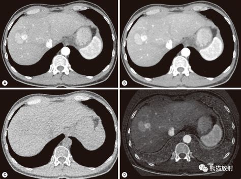 格艾选读丨肝脏影像检查技术（ctmri）对比