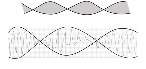 Sine Wave Ecg Pattern