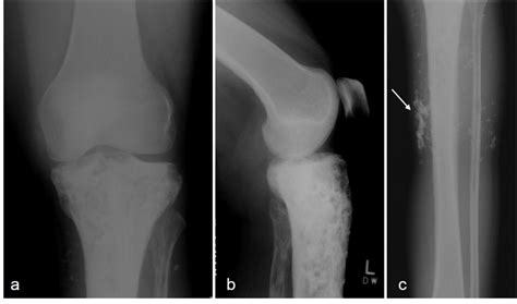 Post Radiation Osteosarcoma Eurorad
