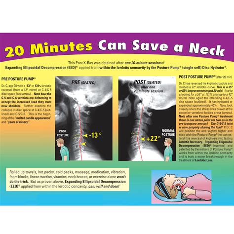 Cervical Kyphosis Exercises