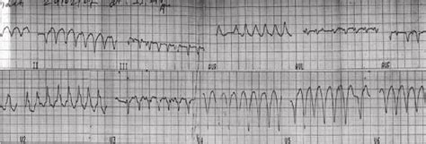 Ventricular Tachycardia Having Right Bundle Branch Block Rbbb