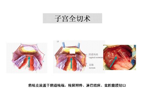 粘克在子宫全切术中的应用上海典范医疗科技有限公司 官方网站 典范上海典范典范医疗科技医用膜可吸收医用膜骨愈膜驻极体静电治疗膜聚