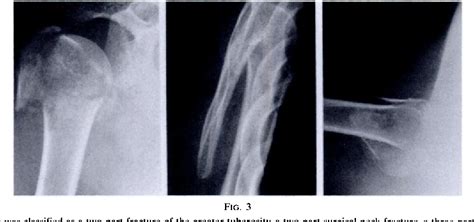 The Neer Classification System For Proximal Humeral Fractures