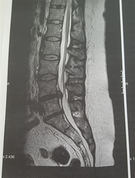 6 Weeks Post Md And Fixing A Stenosis Rsciatica