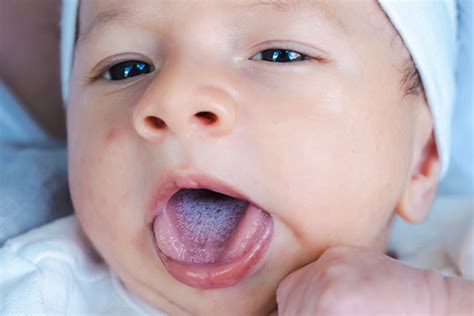 ⊛ Algodoncillo En Bebés Lactantes ⇒ ¡síntomas Y Tratamiento ️
