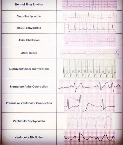 Ekg Reading Medizzy