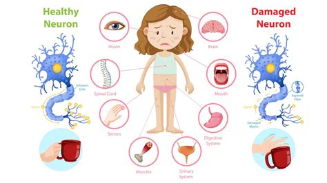 Multiple Sclerosis Symptoms Causes Diagnosis Treatment And Risk