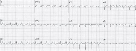 Right Ventricular Hypertrophy Ecg Rvh Ecg Made Easy Gmcmedicine