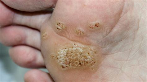 Plantar Warts Symptoms Causes Diagnosis And Treatment