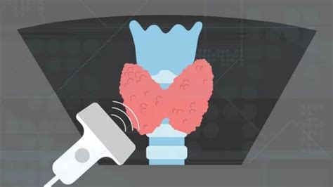 Which Risk Stratification System Is Best For Classifying Thyroid Nodules