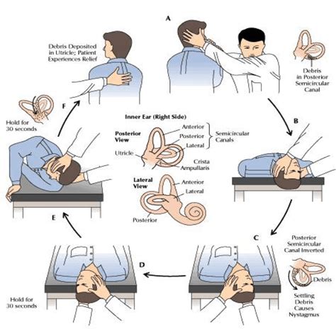Bppv Benign Paroxysmal Positional Vertigo Prometpt