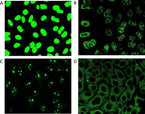 What Are The Different Types Of Ana Patterns At Harry Quintana Blog
