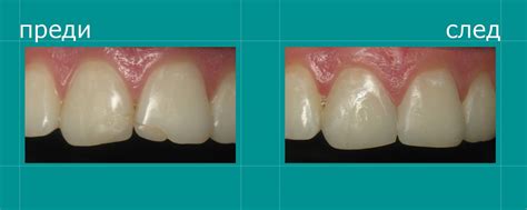 Dentissimo Dental Design Преди Млада пациентка с възстановявания на фронталните зъби които