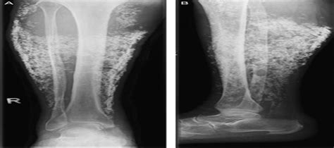 Dystrophic Calcification In Chronic Leg Ulcers—a Clinicopath