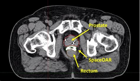 Sbrt Therapy For Prostate Cancer Clearance Cheapest Gt