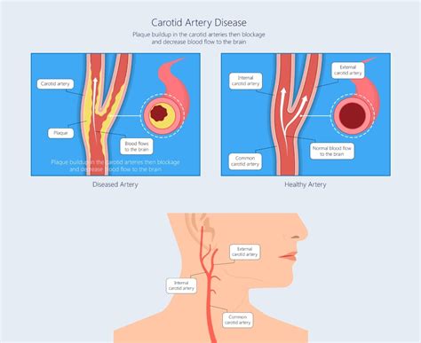 Occluded Carotid Artery Carotisverengung Swiss Surgery