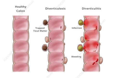 Comparison Of Diverticulosis And Diverticulitis Stock Image C039