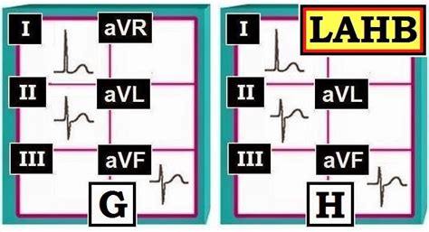Ecg Interpretation Ecg Blog 90 Basic Concepts 3 Axis