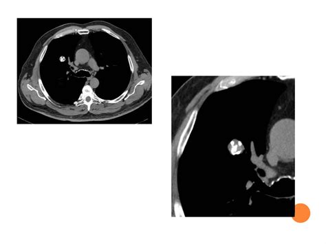 Benign And Malignant Lung Neoplasam Masses Pptx