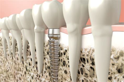 How Do Dental Implants Work Dental Implants In Texas