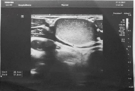Neck Usg Performed At Age 22 Years Visible Cyst In The Suprasternal