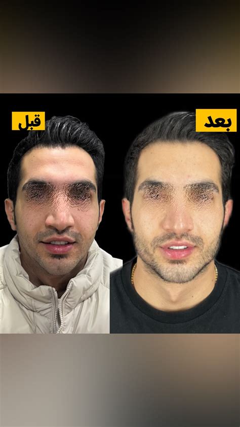 ‎⚜️دکتر شکیبا ⚜️ فیلر،بوتاکس،زیبایی‎ ‎تزریق فیلر در ناحیه زاویه فک و