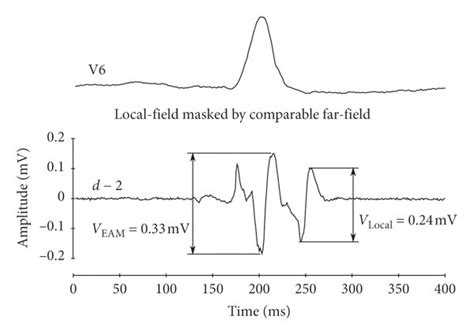 Examples Of A Normal Electrogram Egm Bipolar Voltage Measurement By