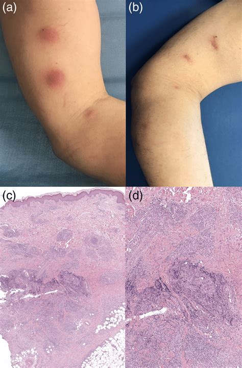A Clinical Appearance Of The Left Arm Subcutaneous Nodules With Download Scientific Diagram