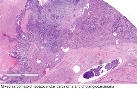 Pathology Outlines Hcc Sarcomatoid Variant