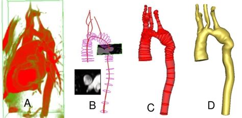 1 Modeling Steps Including A Volume Visualization Of The Vascular