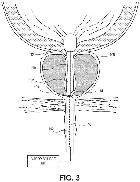 Systems And Methods For Treatment Of Prostatic Tissue Hoey Michael