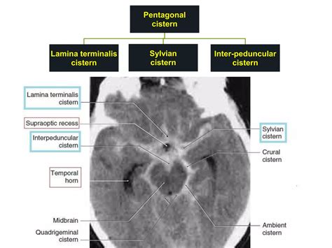 Basal Cisterns Final Ppt
