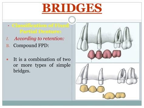 Terminology And Classification Of Fixed Prosthodontics Pdf Oral