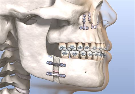 In Depth What Is Orthognathic Surgery And Would You Benefit From It