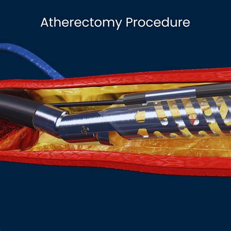 Atherectomy Procedures In Brooklyn